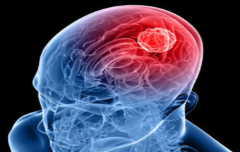 Visão | Cancro está a deixar de ser "incurável" para passar a "doença ...